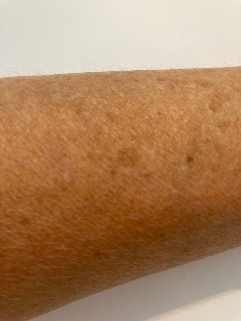 Benign Skin Lesion Removal :: Adsum Aesthetics